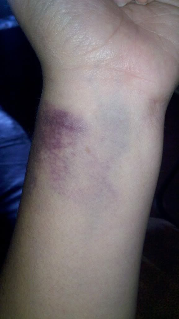 Anyone else look like this? (iv bruising) | BabyCenter